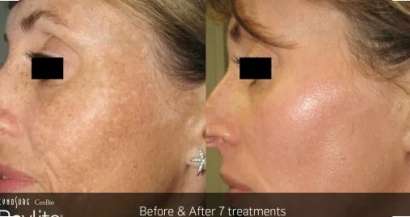 Age spots removal - Laser Skincare and Tattoo Removal by TrustedInkAway LLC