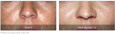 Freckle removal - Laser Skincare and Tattoo Removal by TrustedInkAway LLC
