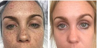 Freckle removal - Laser Skincare and Tattoo Removal by TrustedInkAway LLC
