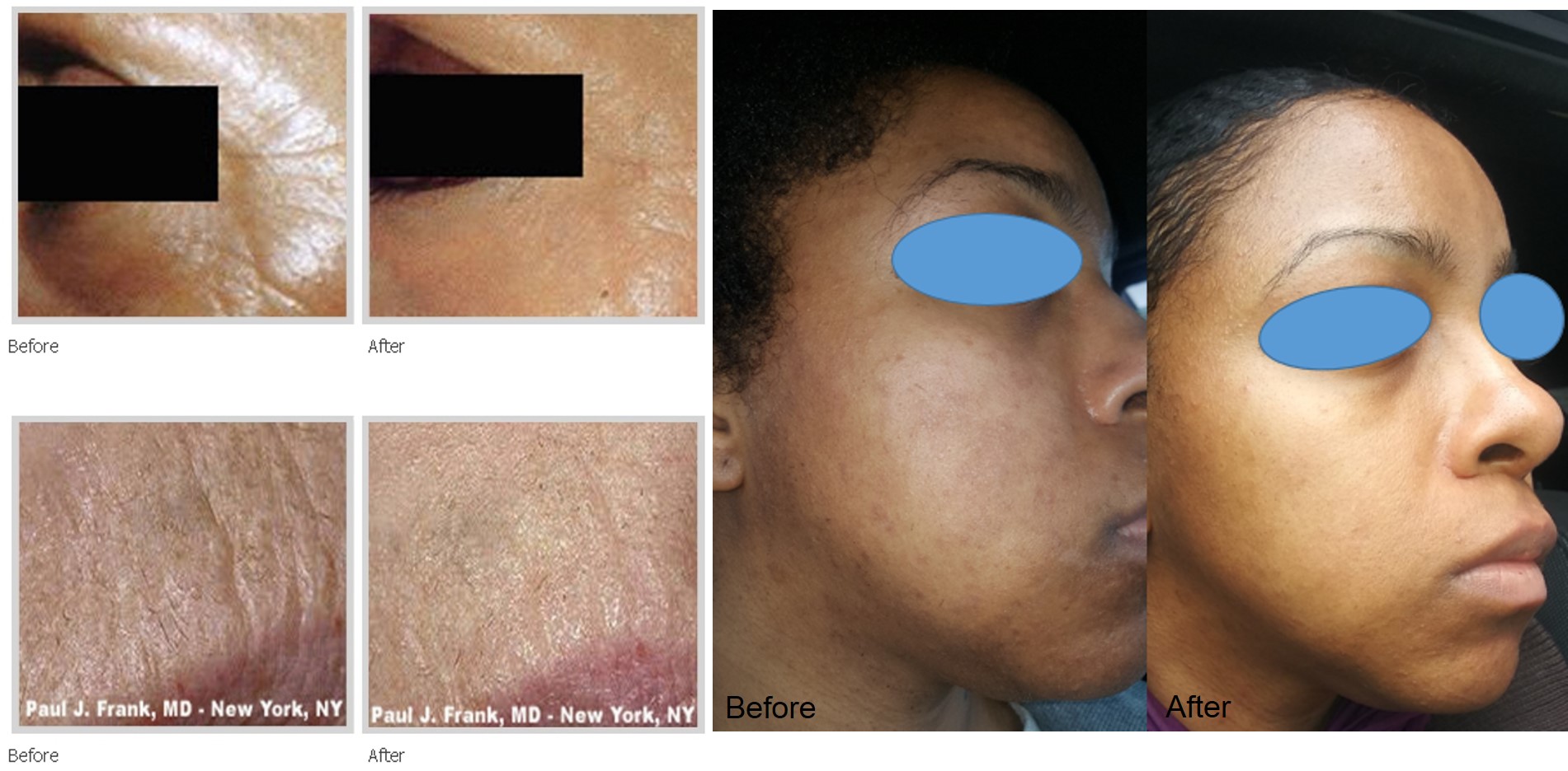 Non-ablative skin rejuvenation with Medlite C6 - Laser Skincare and ...