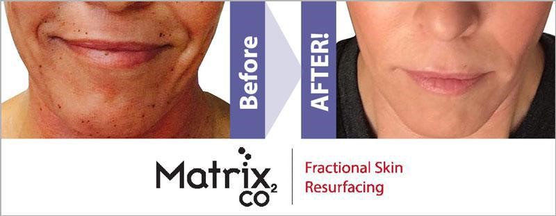 Skin resurfacing with Sandstone Matrix CO2 fractional laser - Laser ...