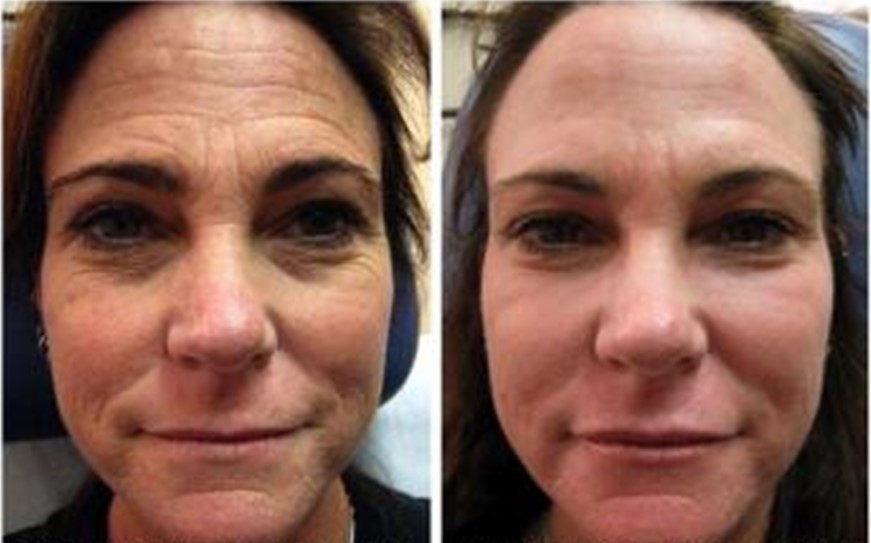 Wrinkle Reduction - Laser Skincare and Tattoo Removal by TrustedInkAway LLC